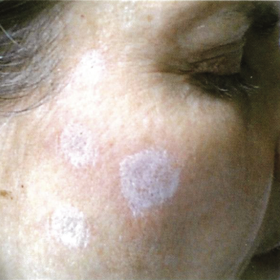 Chemische Peelings Onder de Loep - Dermaesthetics